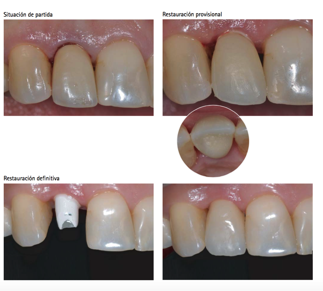 BioHPP: casos clínicos. - Implantes dentales y prótesis. Soluciones en ...