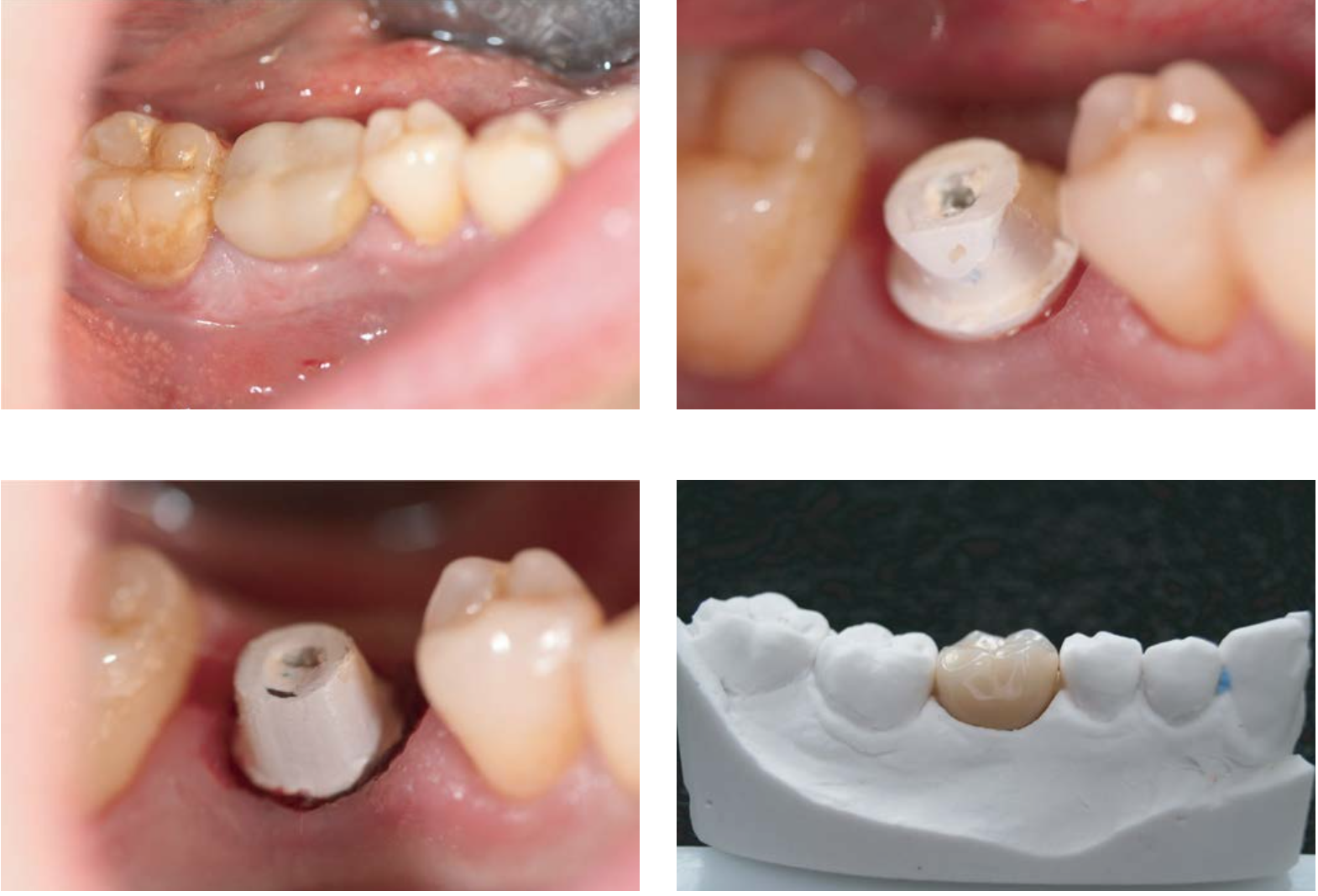 BioHPP SKY elegance: casos clínicos (y 3) - Implantes dentales y ...