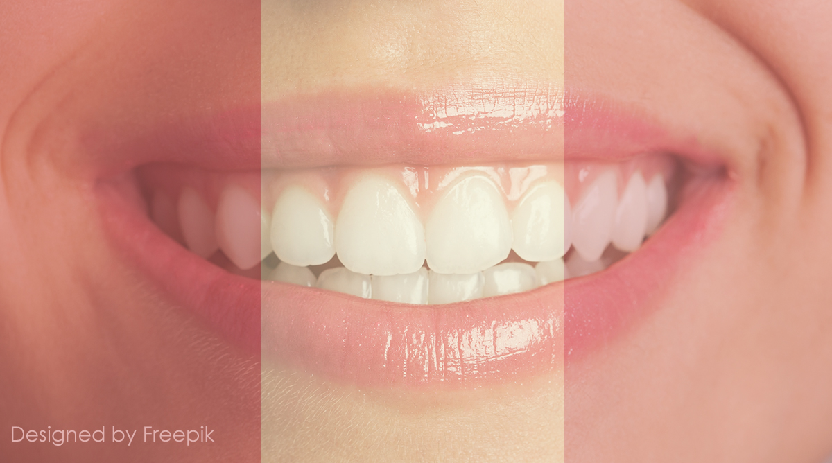 Dientes, encías y lengua: ¿cuál es su color? - Implantes dentales y ...